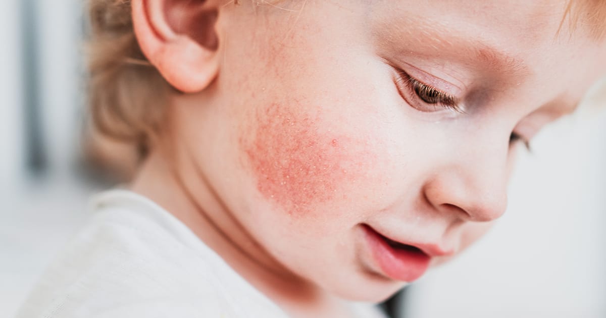 Parvovirus B19 | American Lung Association