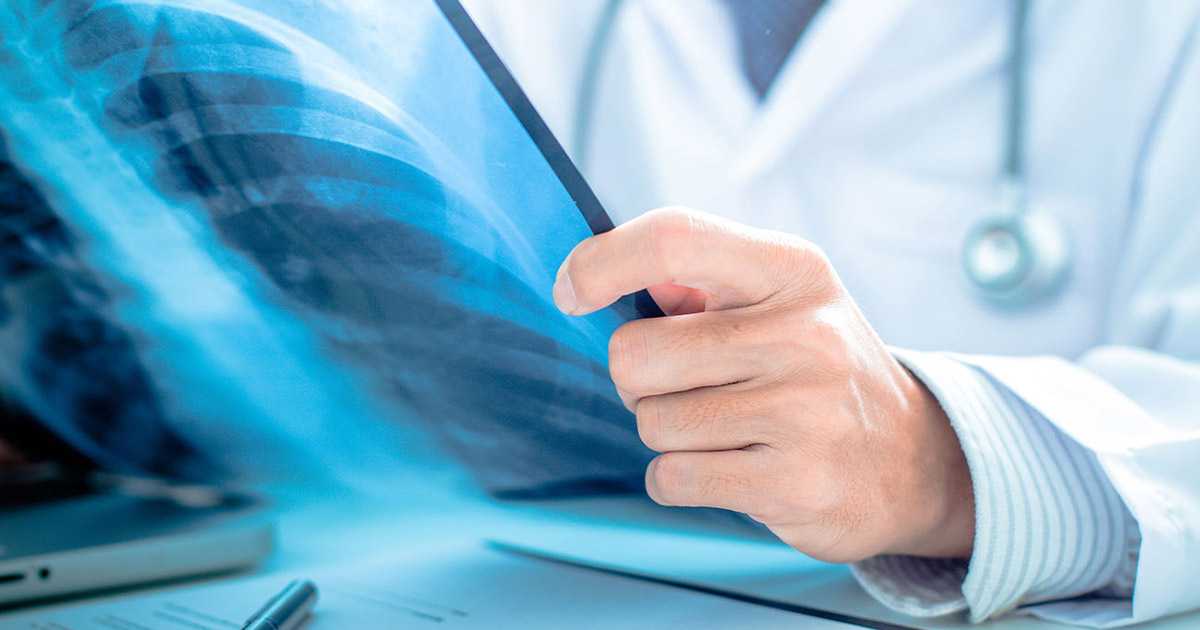 Lung Cancer Interception Team | American Lung Association