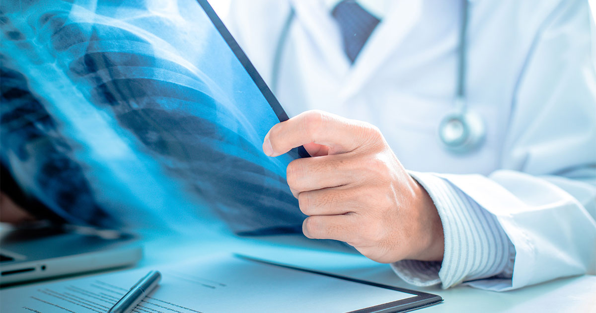 Lung Cancer Staging | American Lung Association