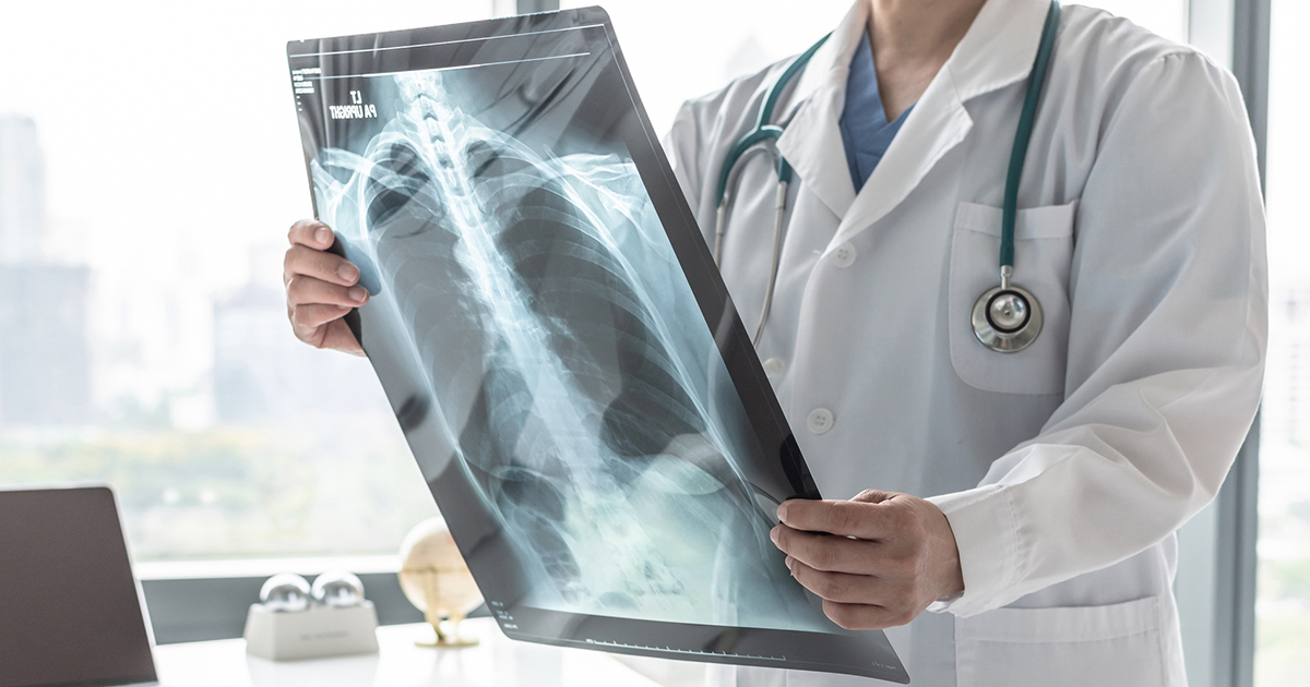 Stopping Lung Cancer Before It Progresses: $3 Million Research ...